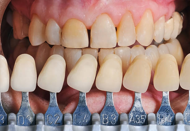 Dr. Dömösi Ágnes Fogszakorvos Győr - Fogfehérítés